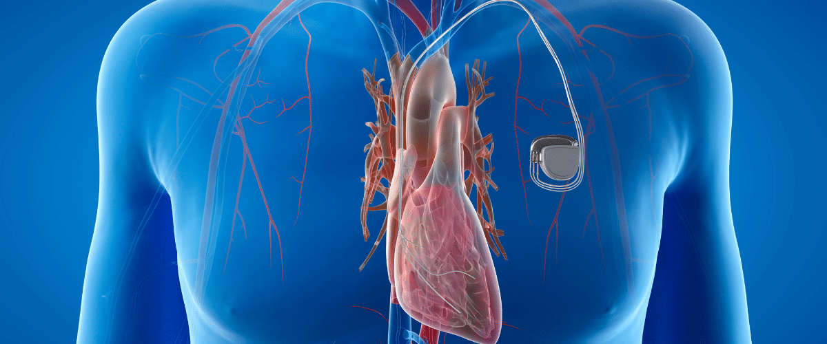 AICD (automatic implantable cardioverter defibrillator)